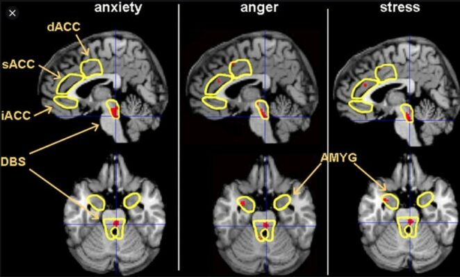 This Is What Brain Imaging Reveals About Anxiety & Depression ...