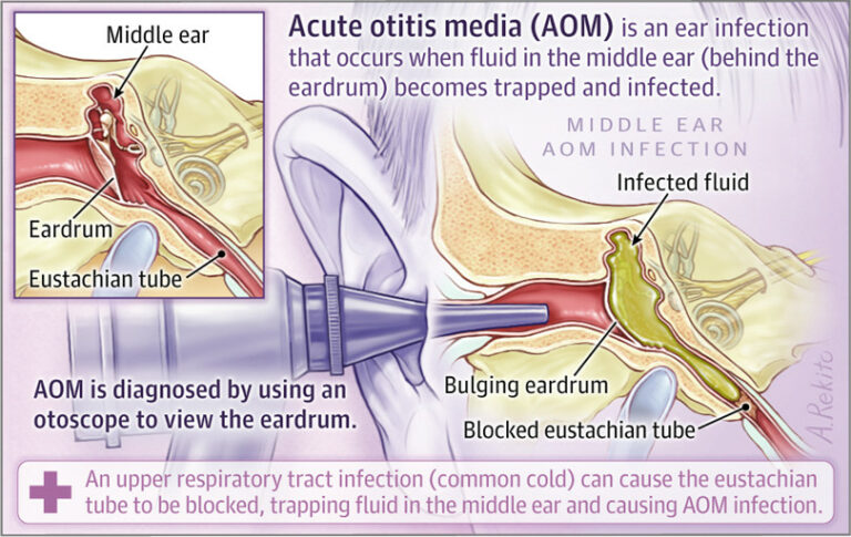 Signs Of Ear Infection In Toddlers & Other Things To Know